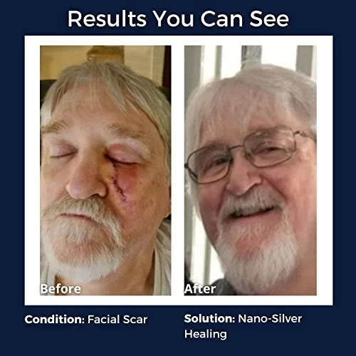 Optivida Colloidal Silver Gel Cream For Wound Care, Natural Topical ...